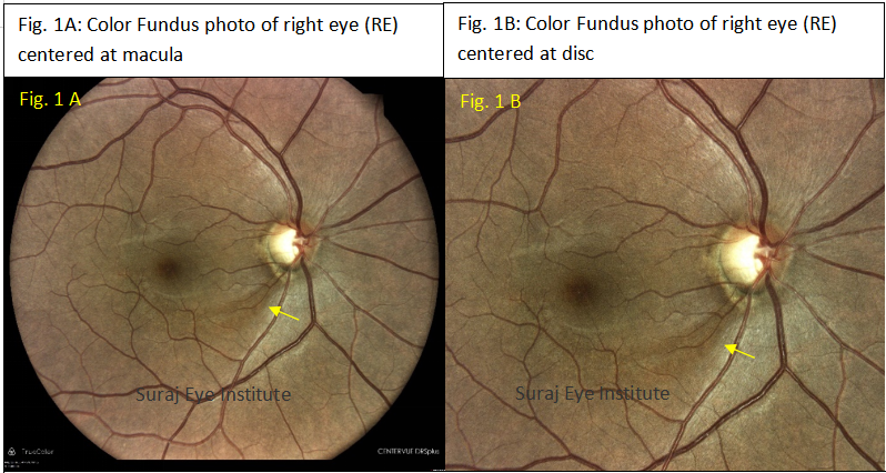 GlaucomaLearn 5 (Left eye) - Suraj Eye Institute