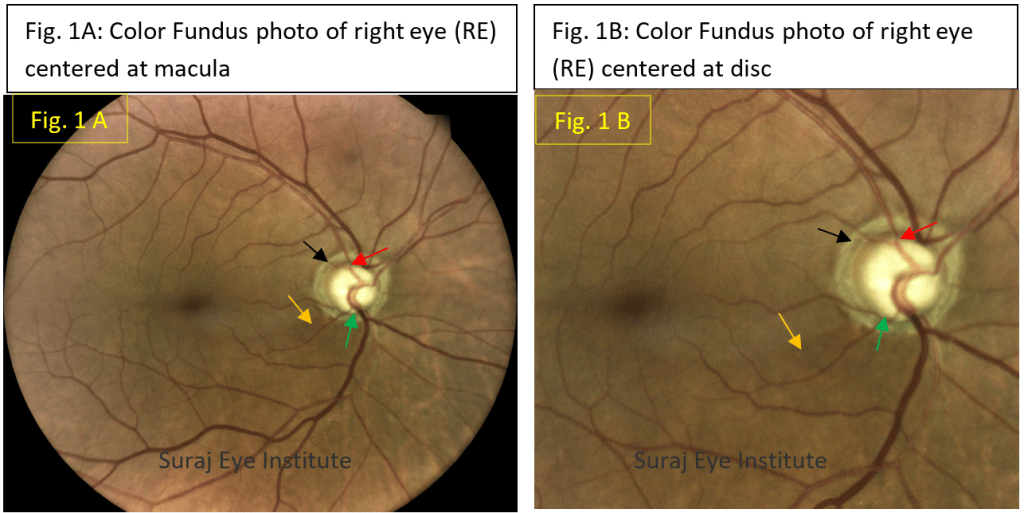 GlaucomaLearn 3 (Right eye) - Suraj Eye Institute