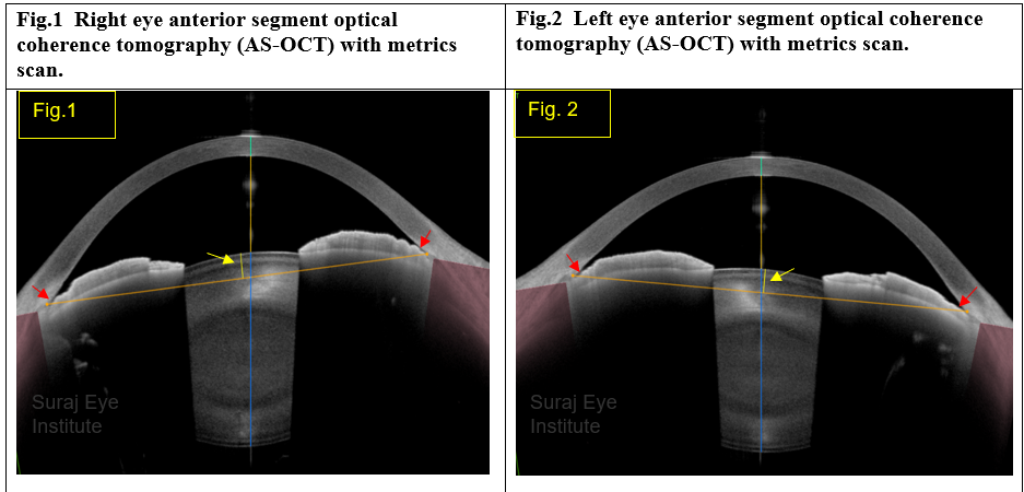 Imagewise 65 -Occludable angles, glaucoma, and retinal nerve fiber loss ...