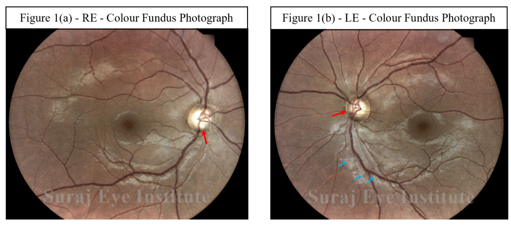 Spark ImageWise 79 - RNFL loss without macular GCL loss - Suraj Eye ...